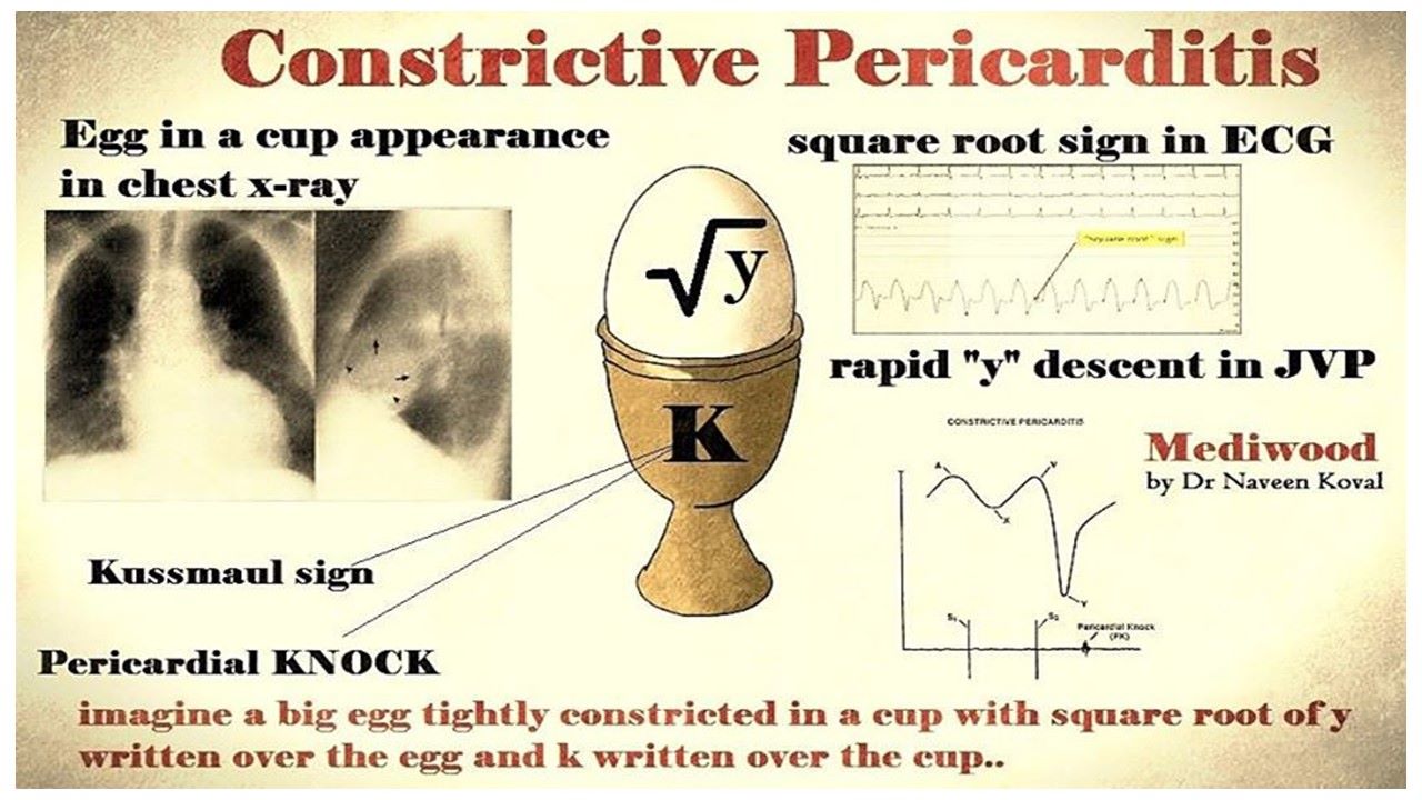 Constrictive Pericarditis Square Root Sign