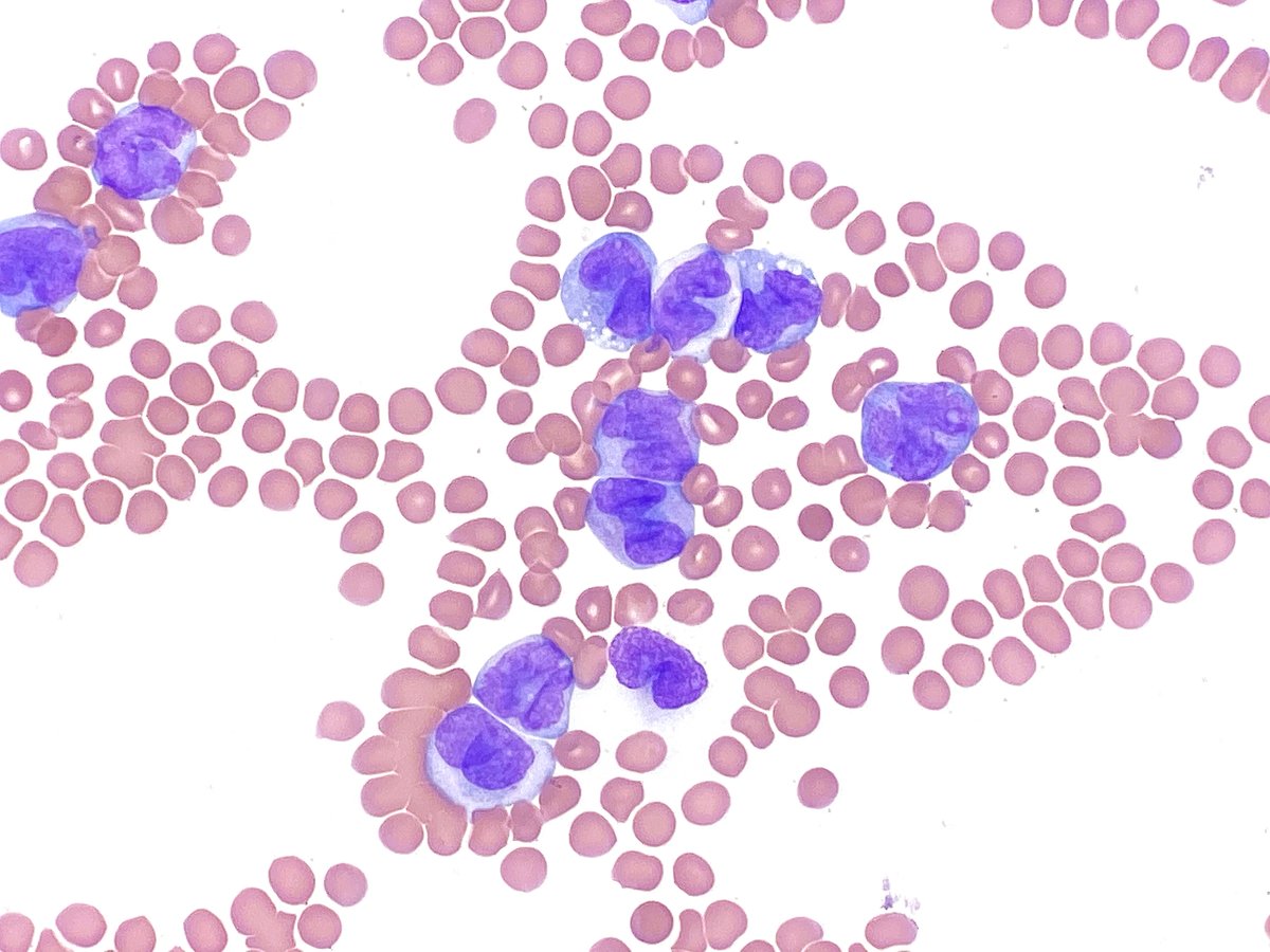 Acute Promyelocytic Leukemia Microgranular Variant
