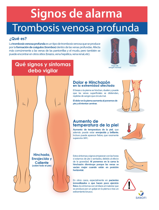Trombosis Venosa Profunda: Qué Es, Causas, Síntomas, Tratamiento Y ...