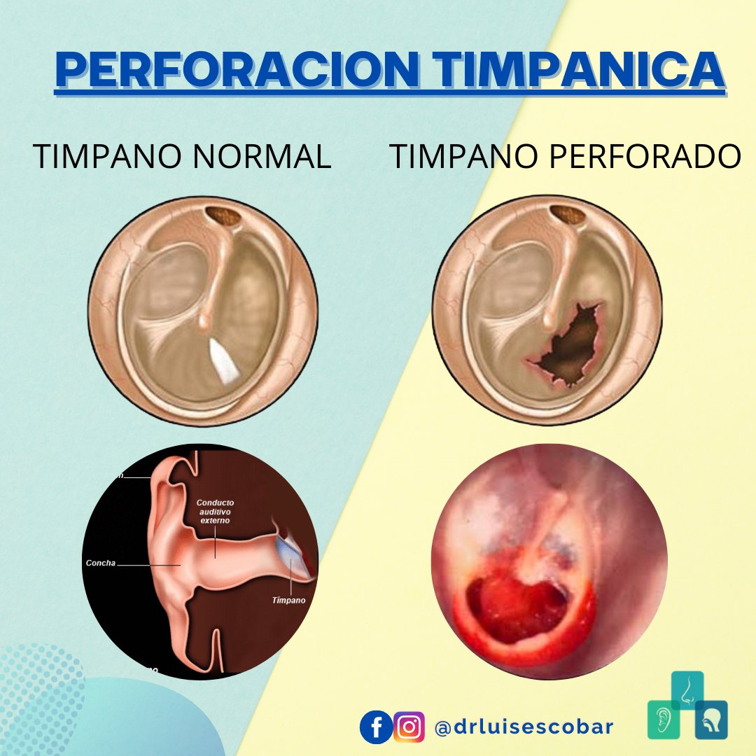 Para Castigar Megalópolis Ser Amado Timpano Perforado Dulce Vertical Flotar