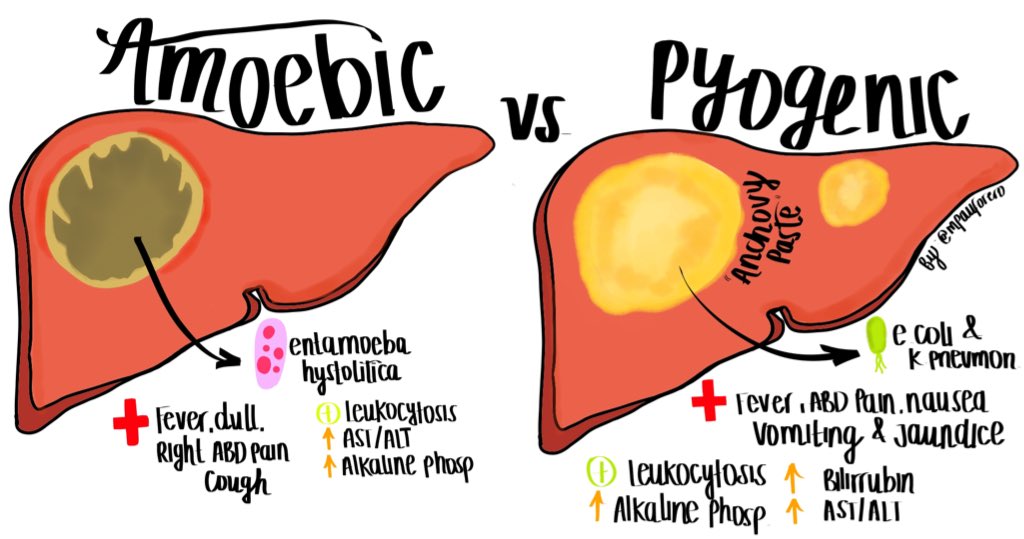 Anchovy Sauce Liver Abscess