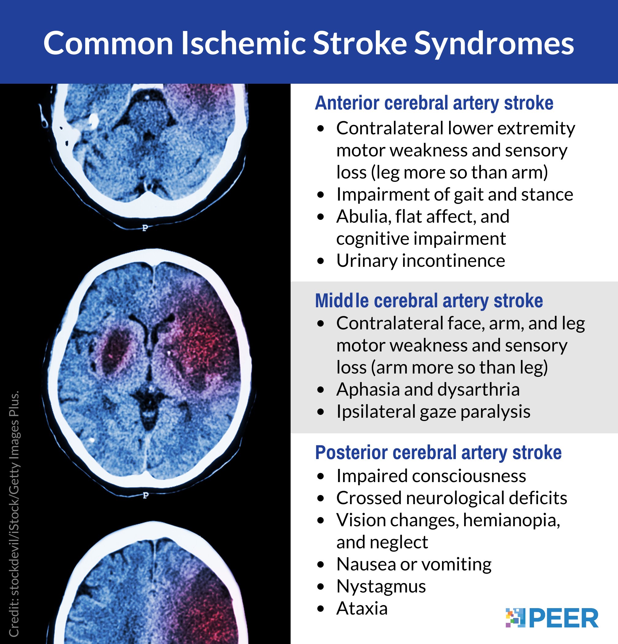 Middle Cerebral Artery Stroke