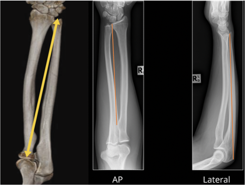 Bicipital Tuberosity Of Radius Radiology