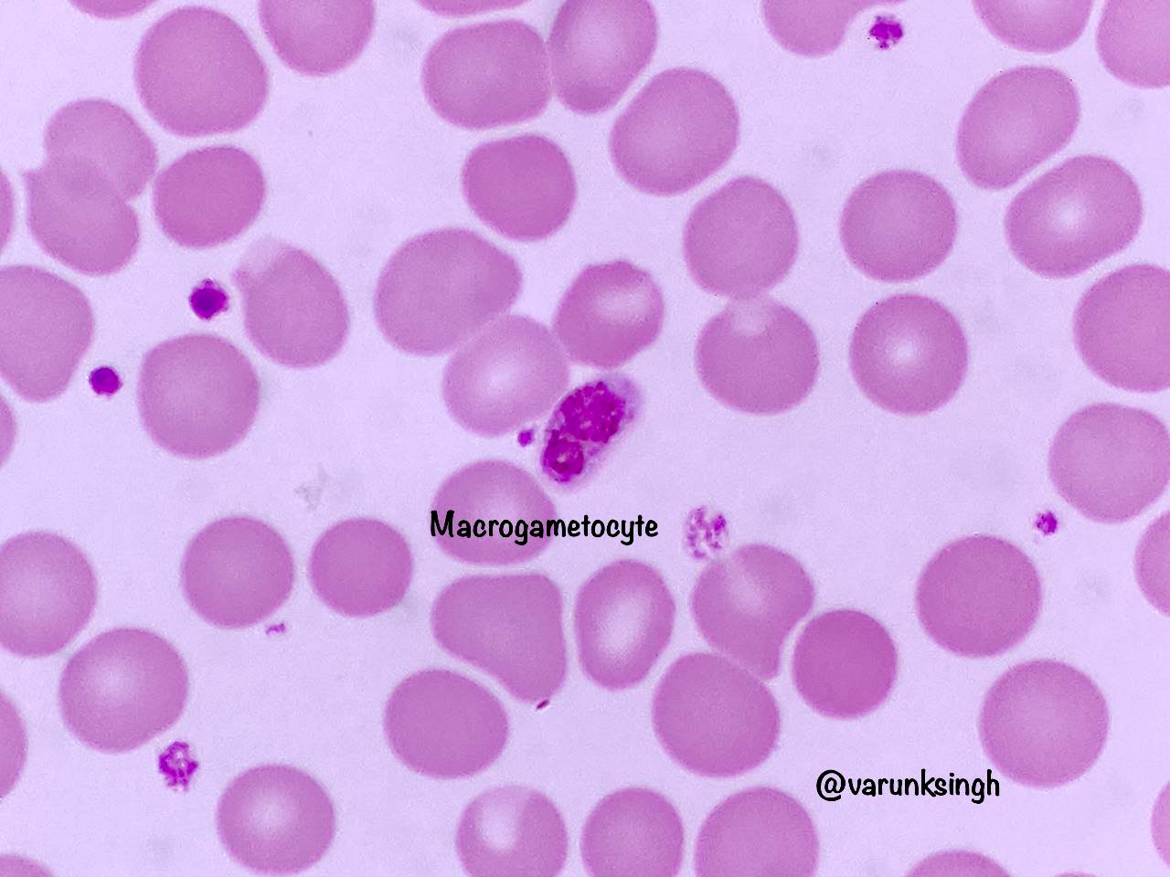 Plasmodium Falciparum Microgametocyte