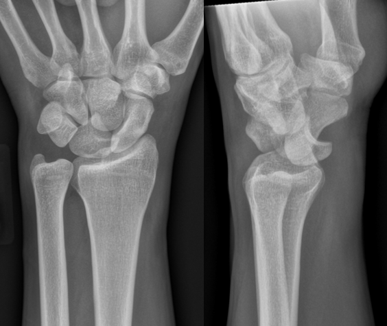 Lunate Dislocation Pie Sign