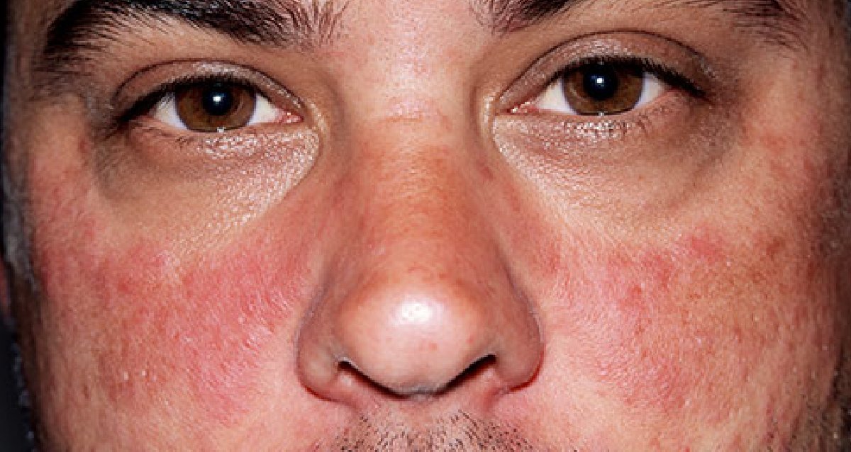 Butterfly Shaped Rash Across Cheeks And Nose Lupus Rashes (With
