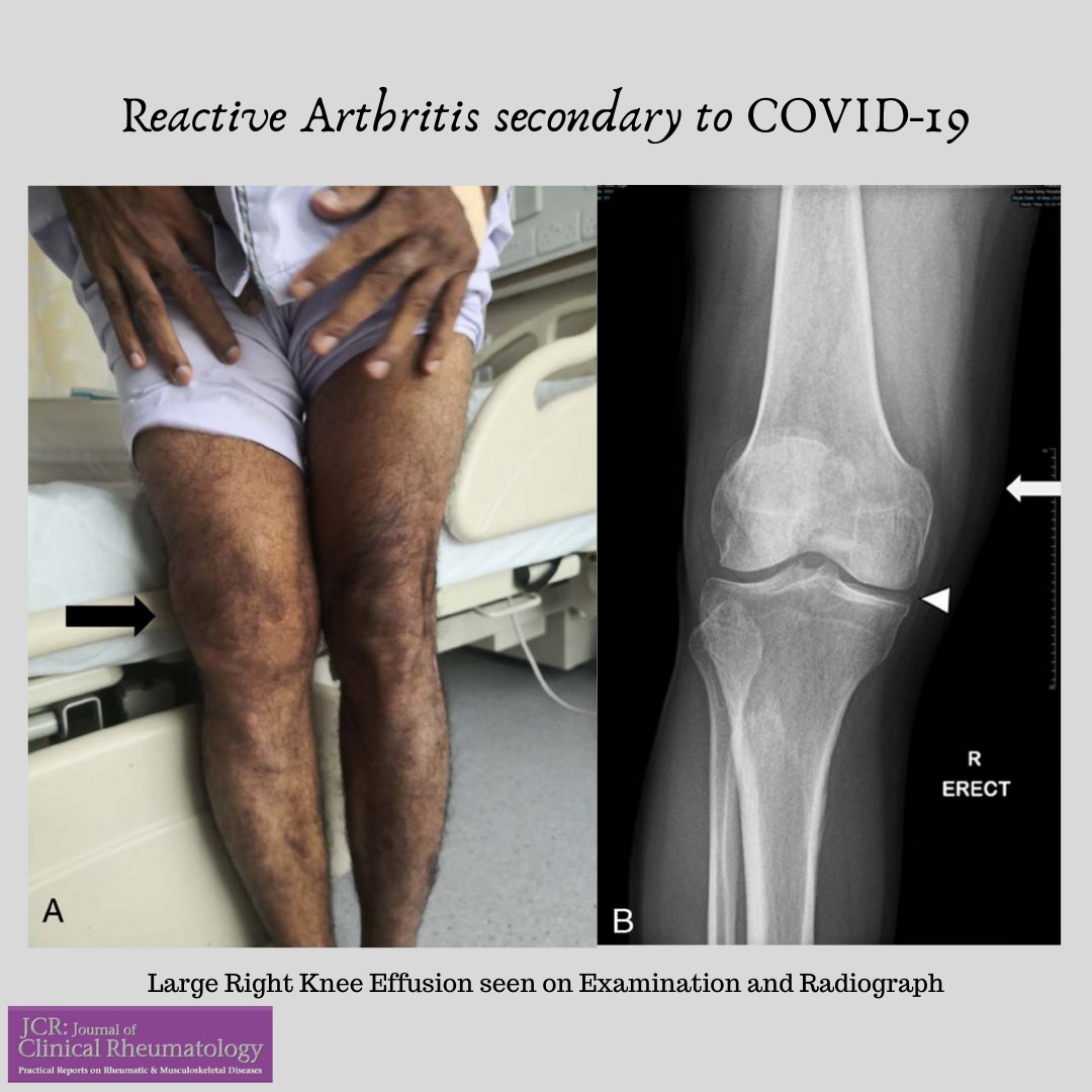 Reactive Arthritis Knee