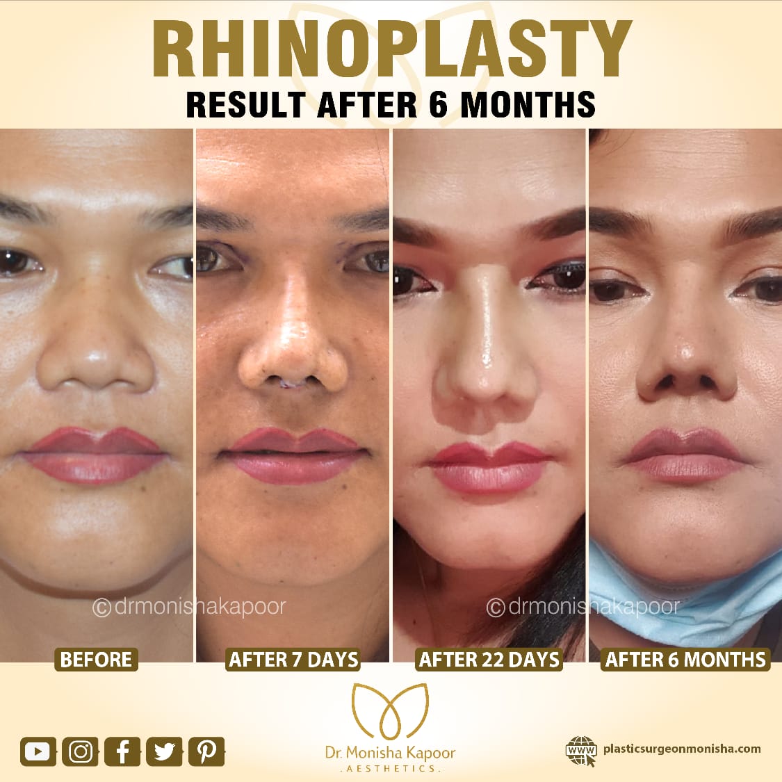 Rhinoplasty Recovery Day 7