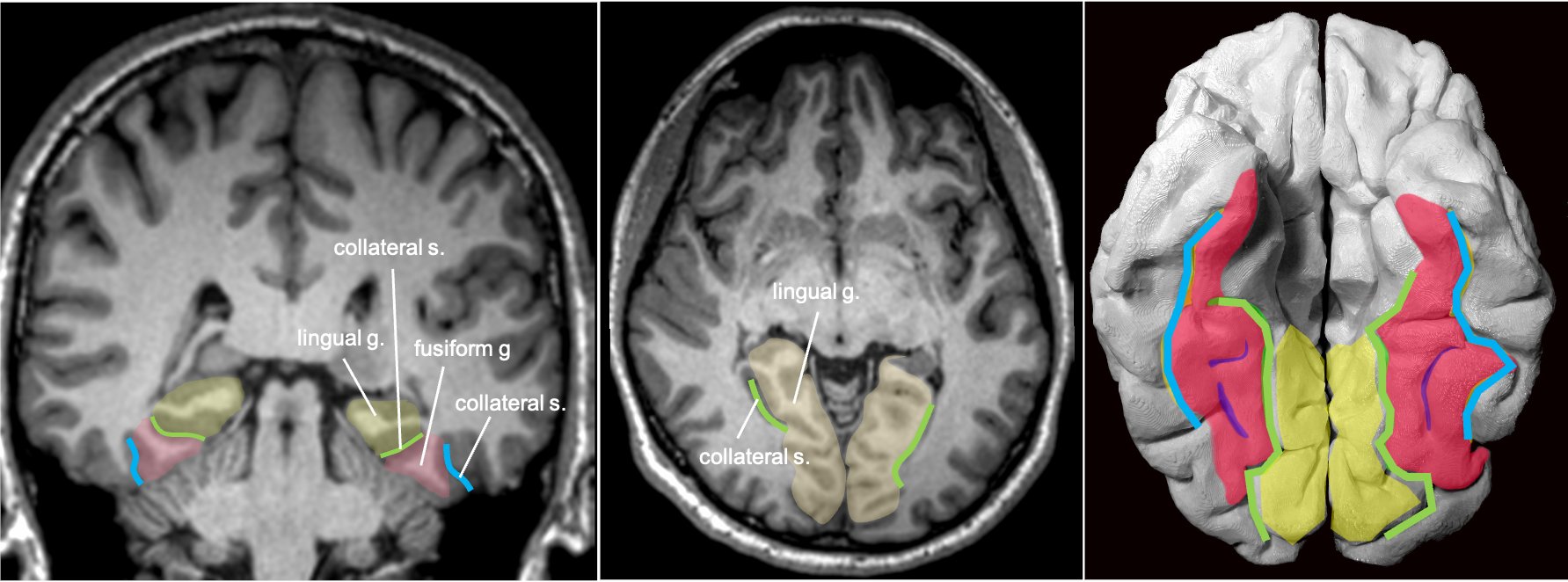 Fusiform Gyrus Coronal