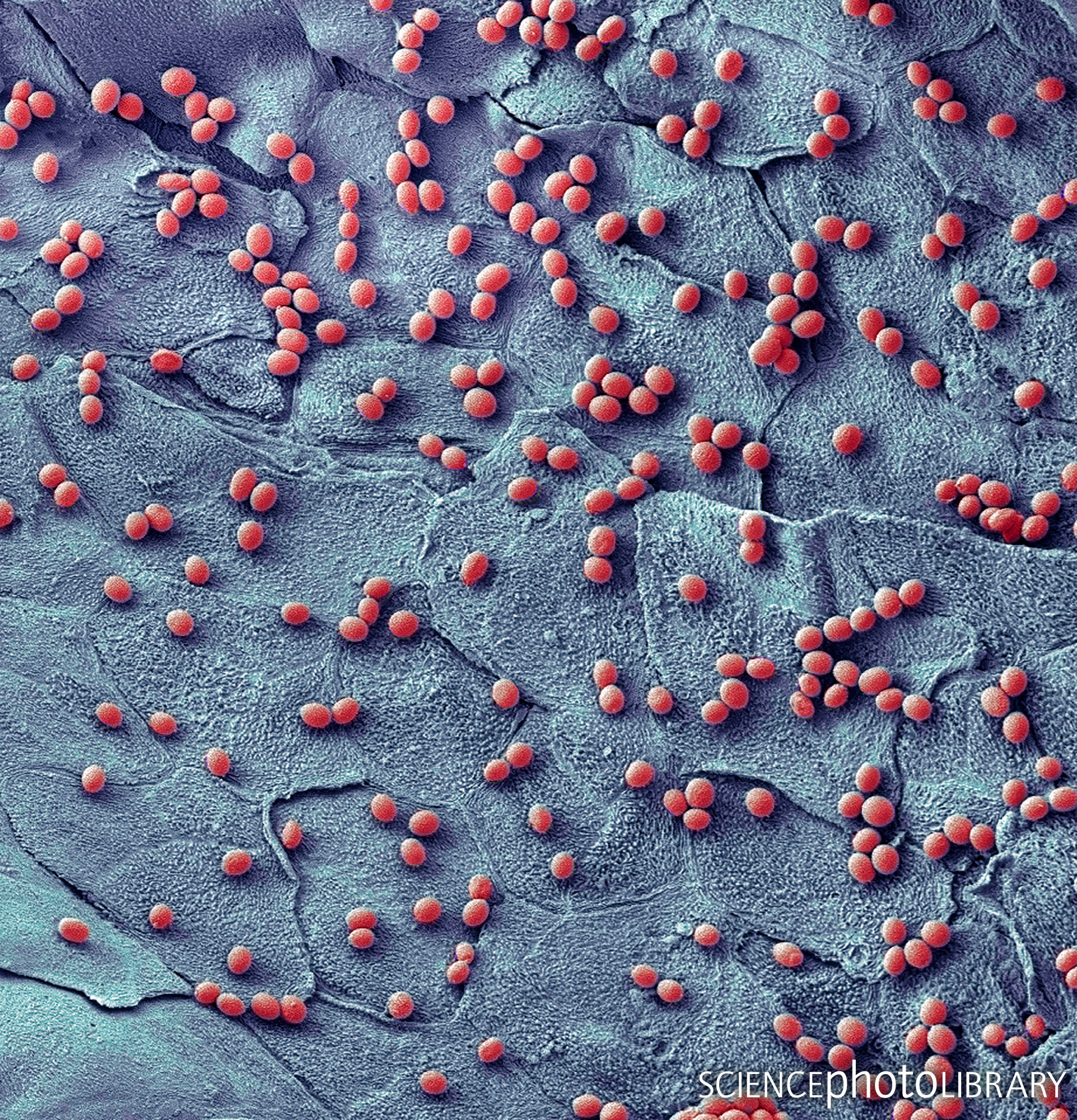Tinea Pedis Microscope