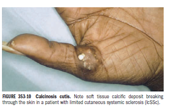 Calcinosis Cutis Scleroderma