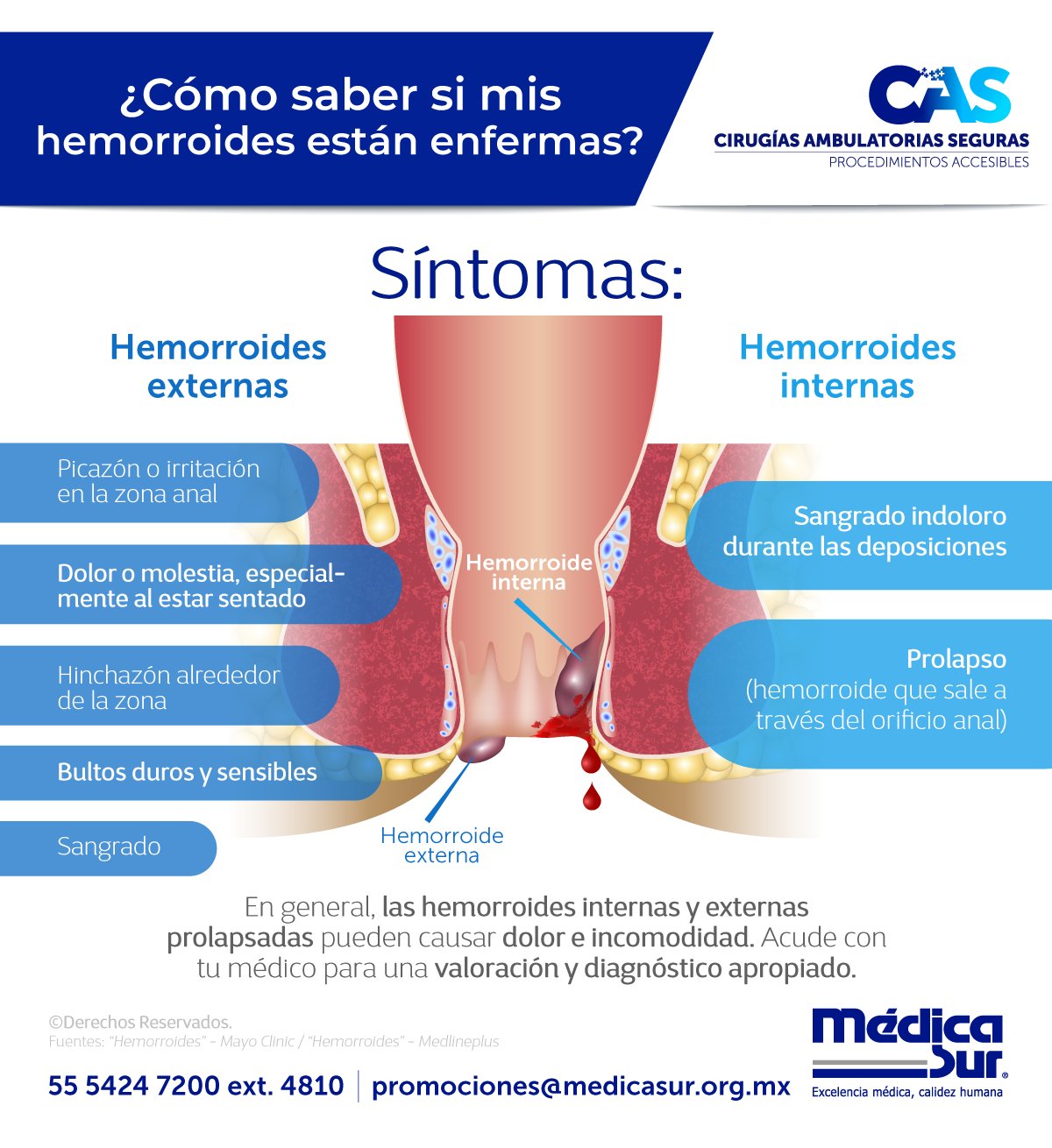 Hemorroides Internas Sintomas