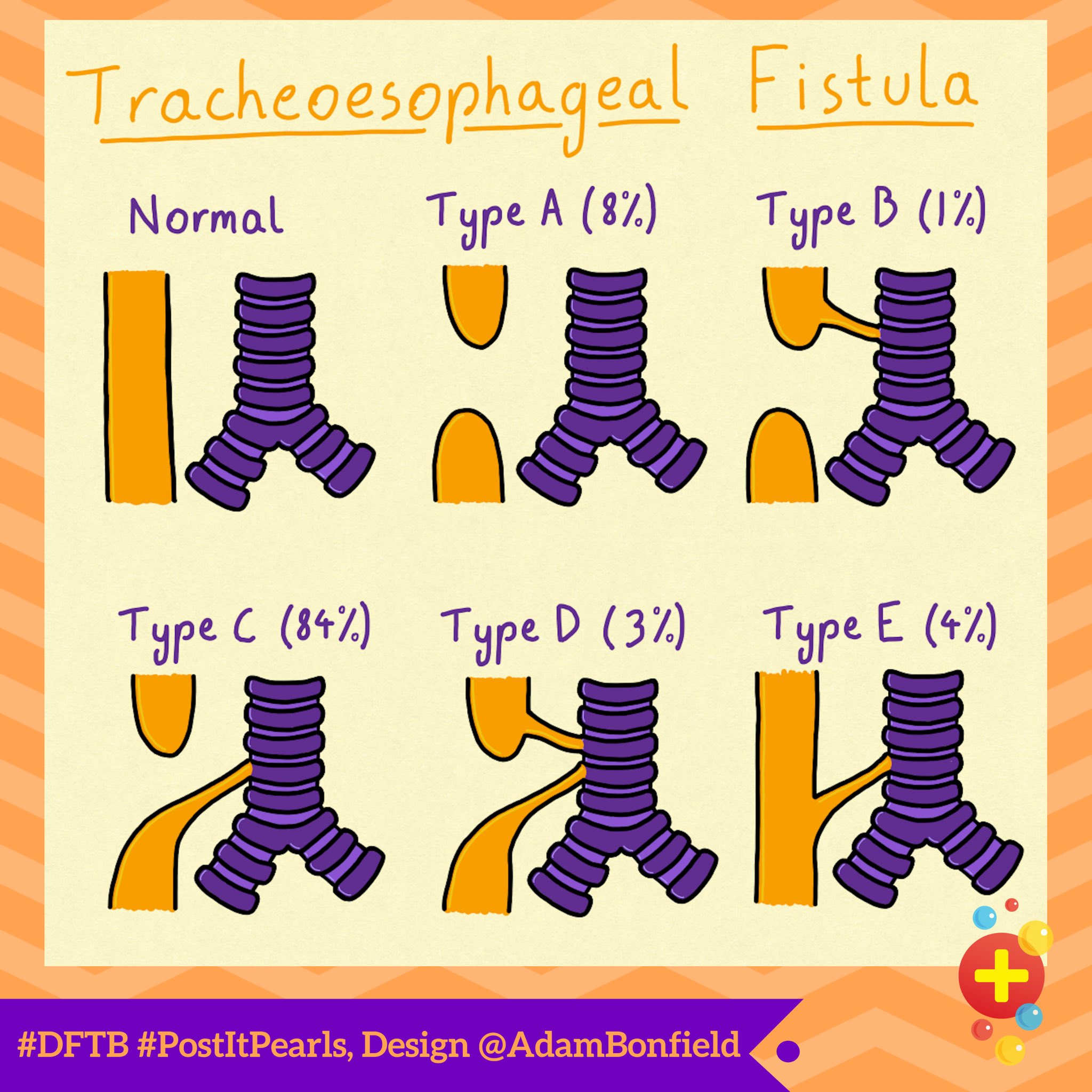 Tracheoesophageal Fistula