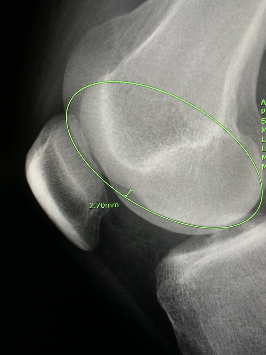 Sulcus Terminalis Femur