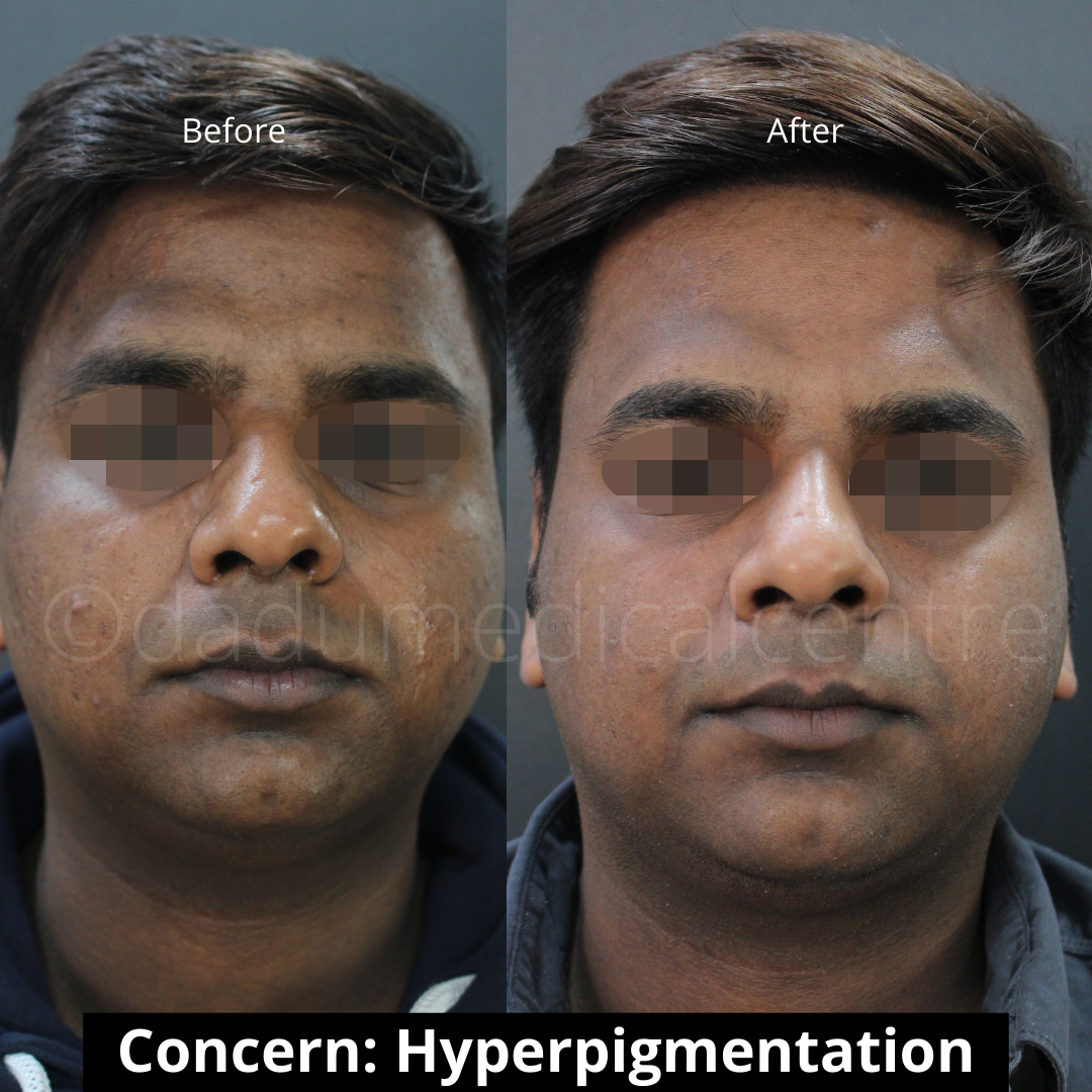 Hyperpigmentation Face Before And After