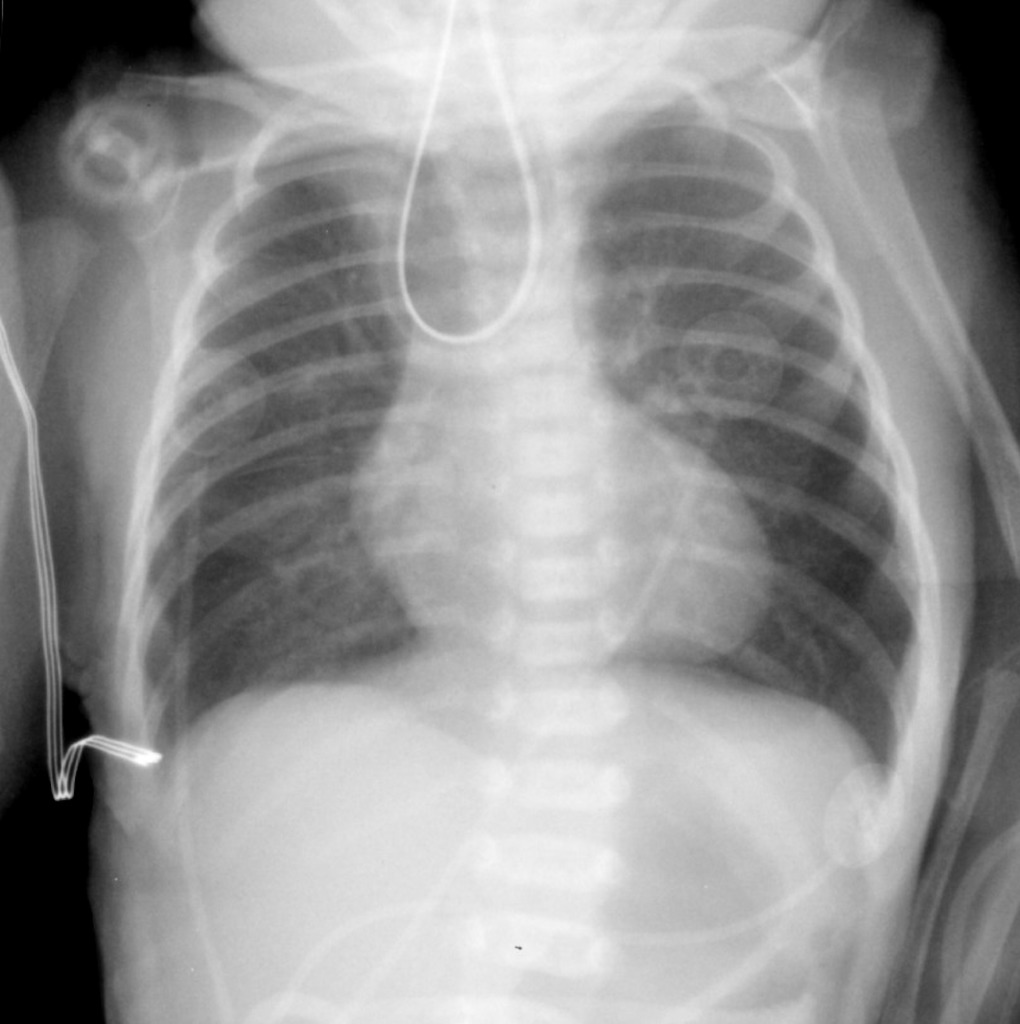 Esophageal Atresia X Ray
