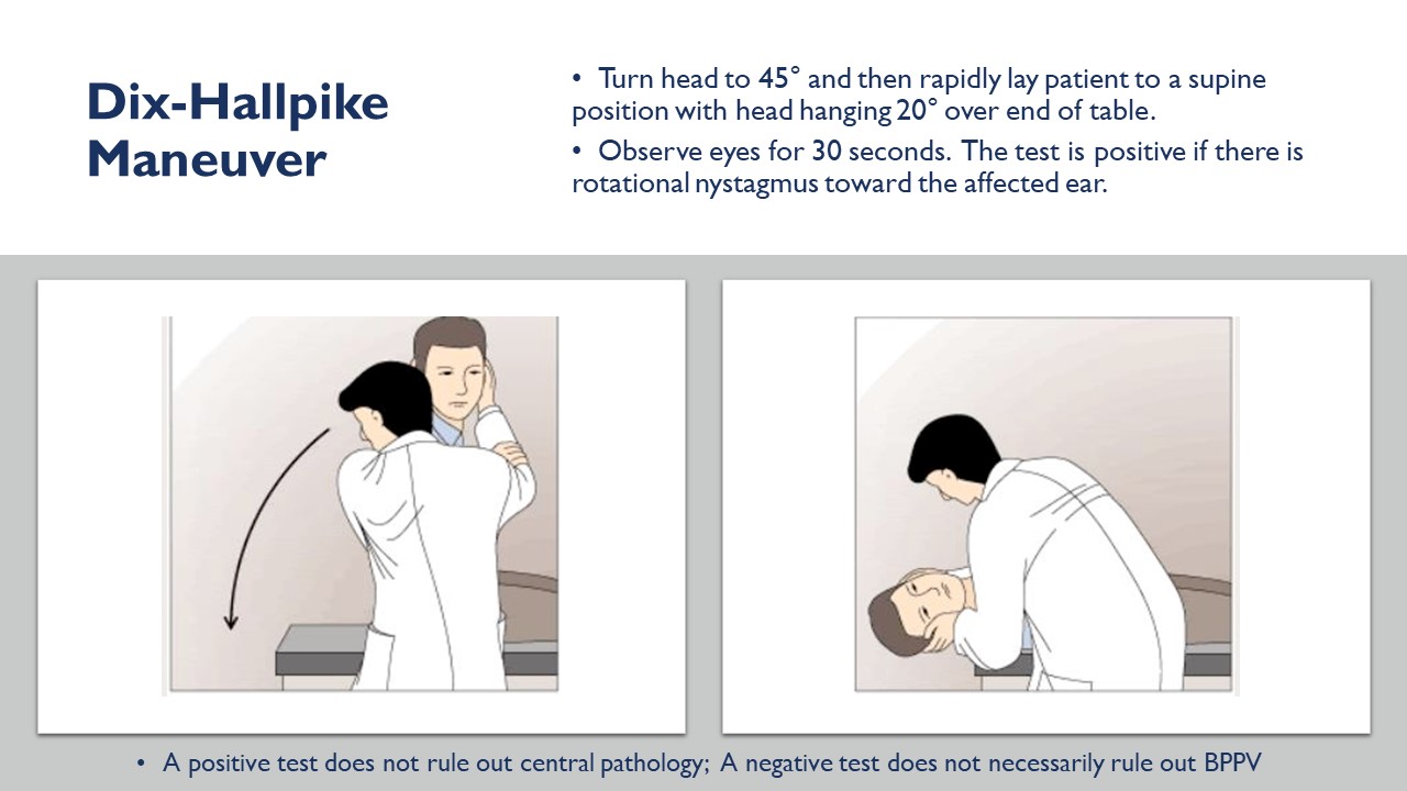 Dix Hallpike Maneuver Illustration Bppv Benign Paroxysmal