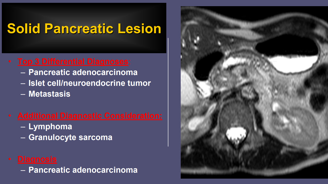 Serous Cystadenoma Pancreas Ultrasound