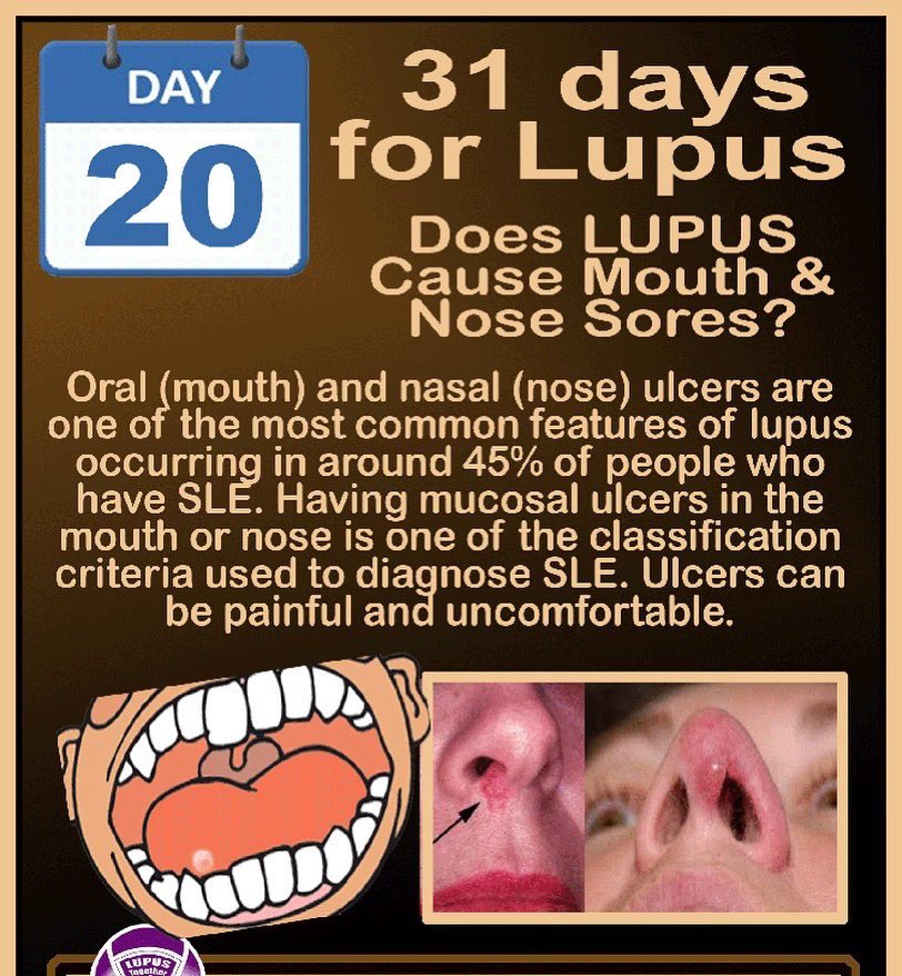Sores In Mouth From Lupus