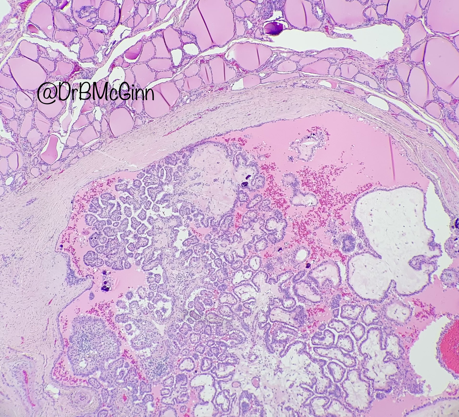 Multinodular Goiter Histology