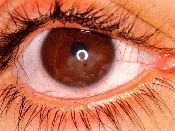 Distichiasis Eye Lashes Double