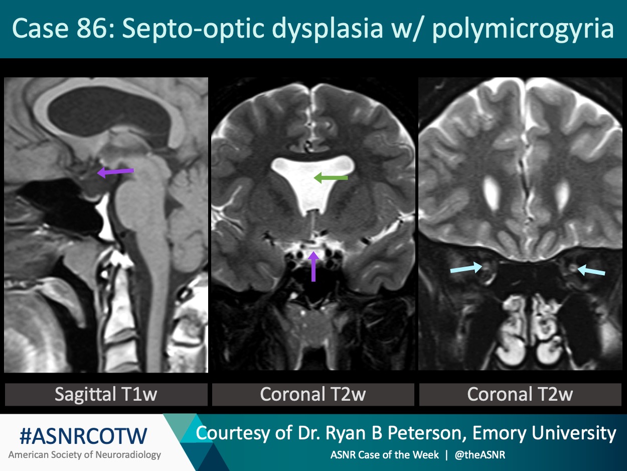 Septo Optic Dysplasia Mri