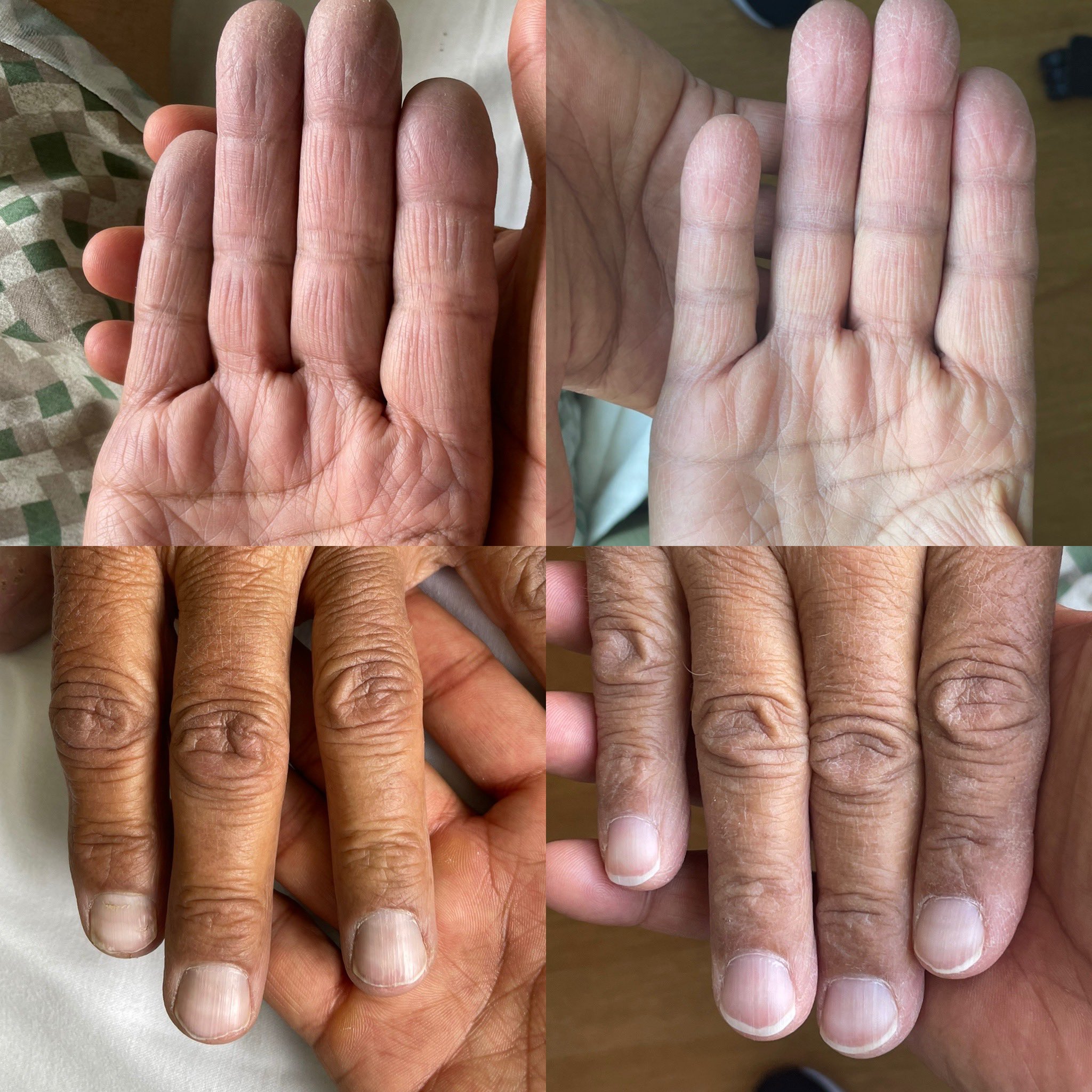 Peripheral Cyanosis
