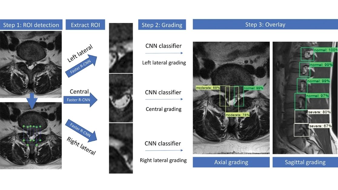 Spinal Stenosis Mri