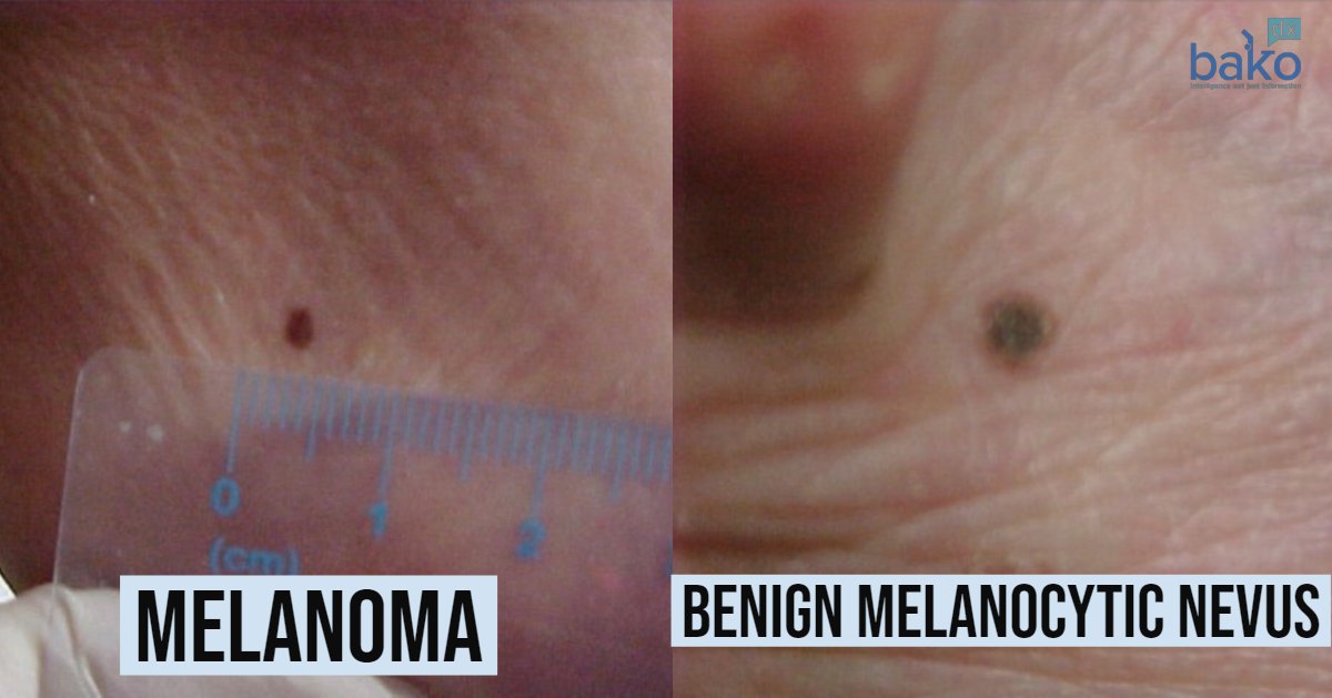 Melanocytic Nevus Vs Melanoma