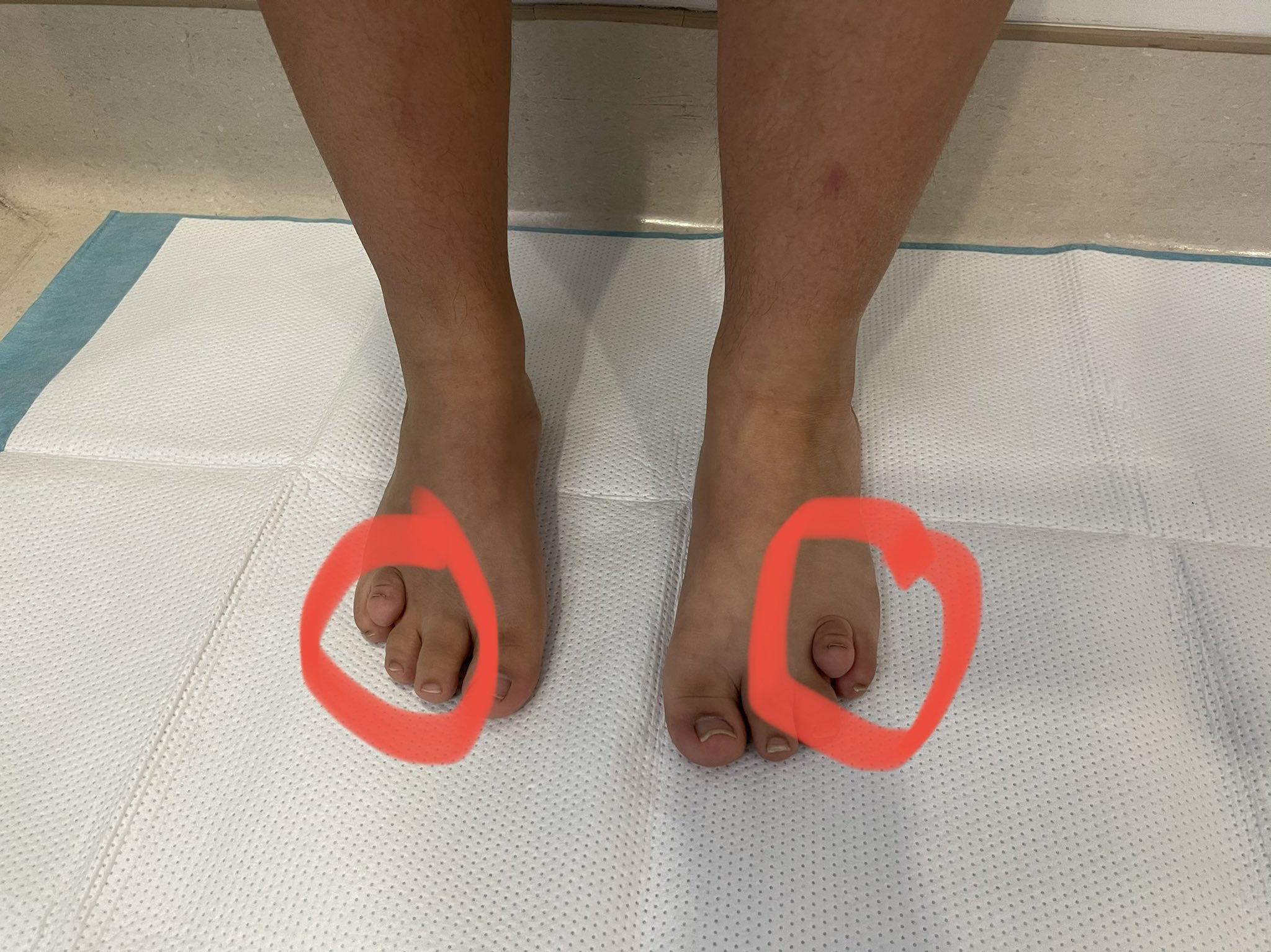 Toe Deformities Daniel Nunes | atelier-yuwa.ciao.jp