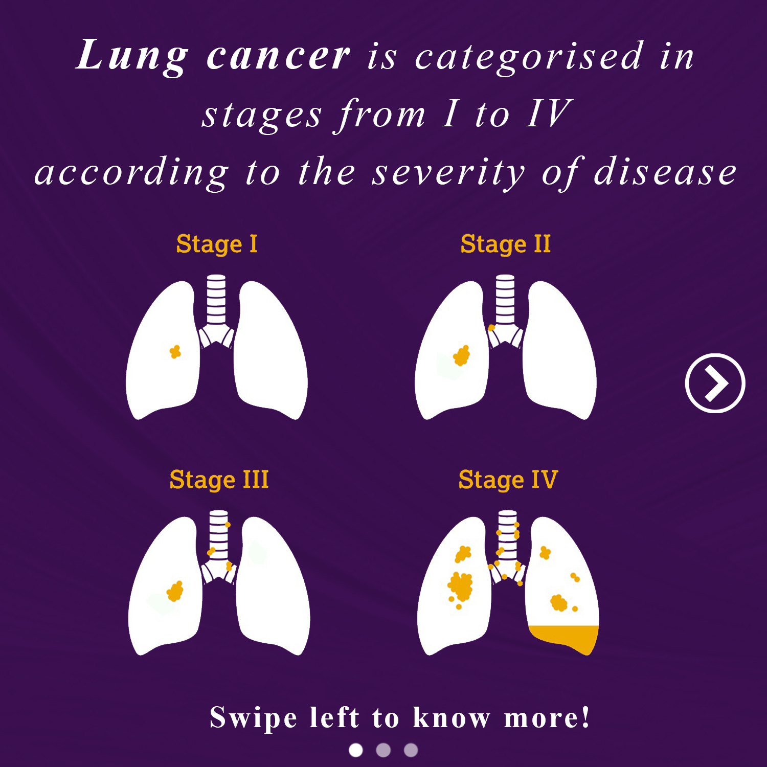 Stage 4 Cancer Life Expectancy
