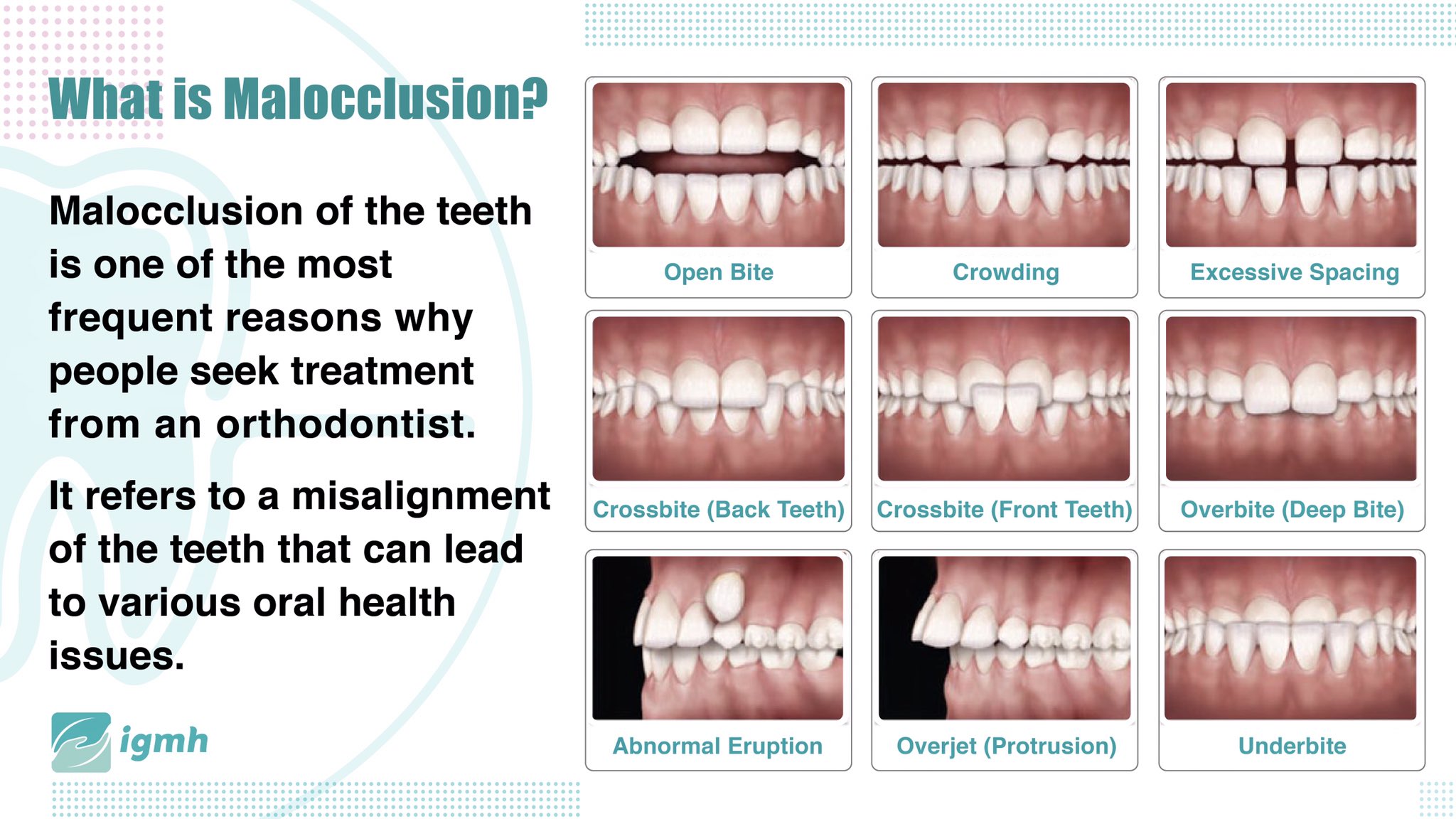 Types Of Malocclusion Of Teeth