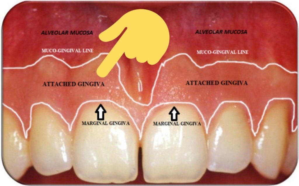 Mucogingival Junction