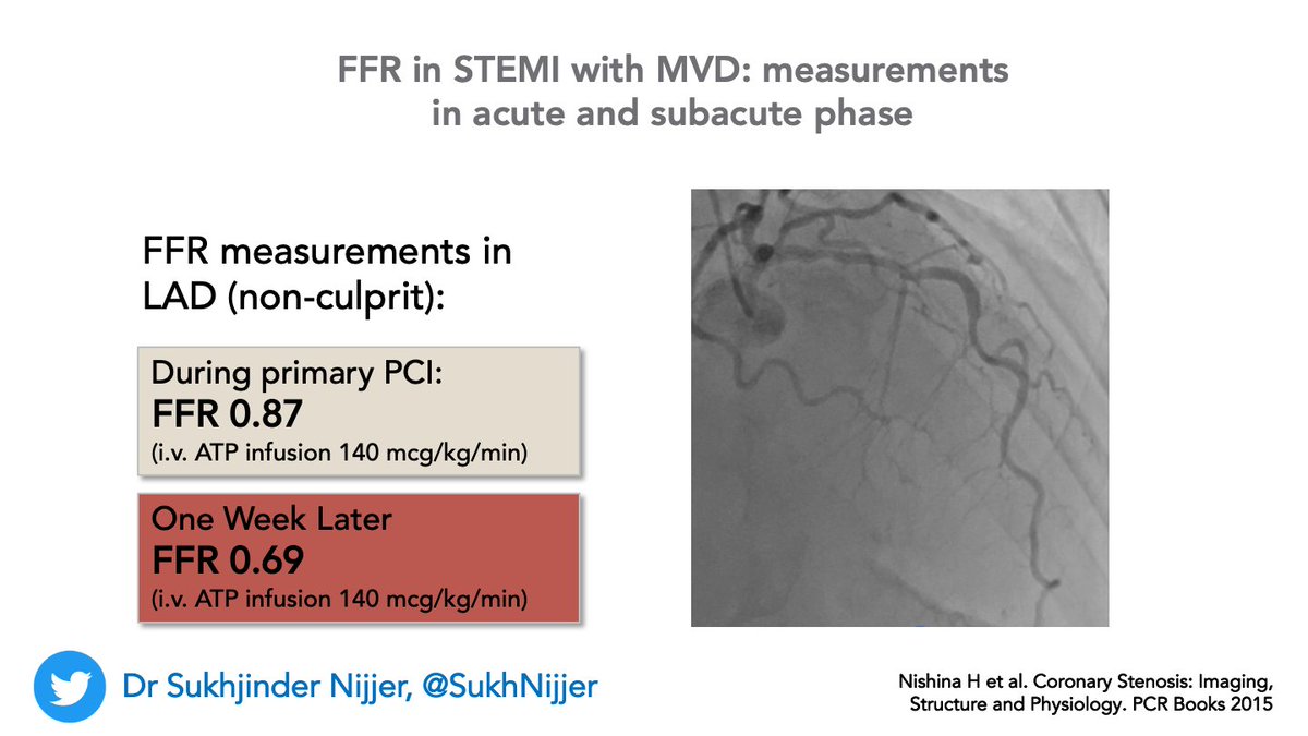 FFR in ACS? Should we stop doing it now that FLOWER-MI shows no ...
