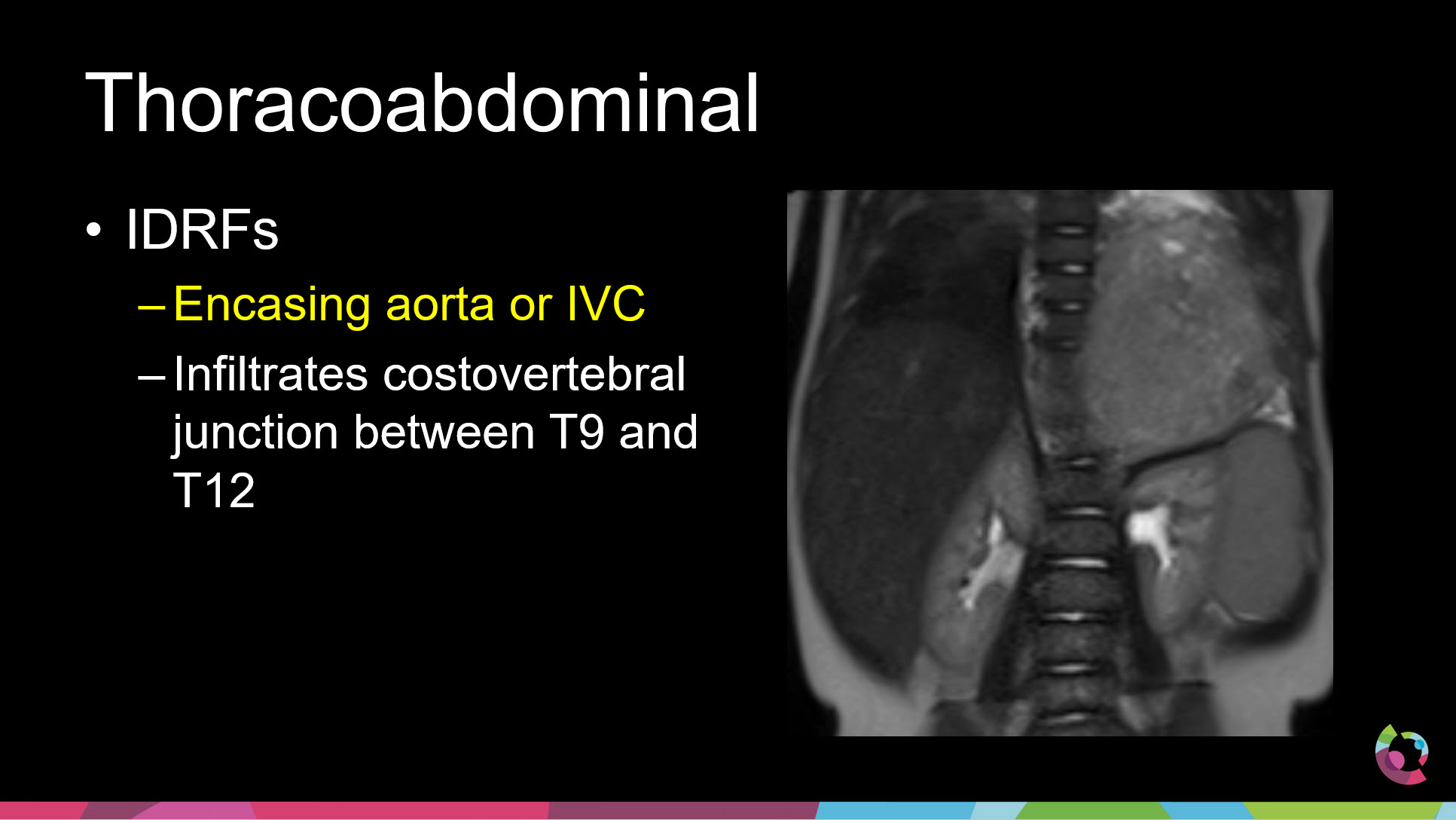 Costovertebral Junction