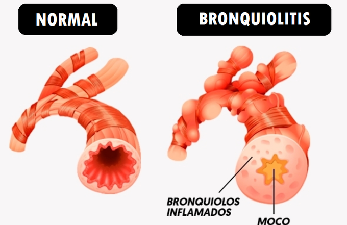 ¿Qué es la bronquiolitis? – Homo medicus ¿Qué es la bronquiolitis? – Homo medicus