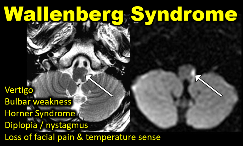 Wallenberg Syndrome Mri