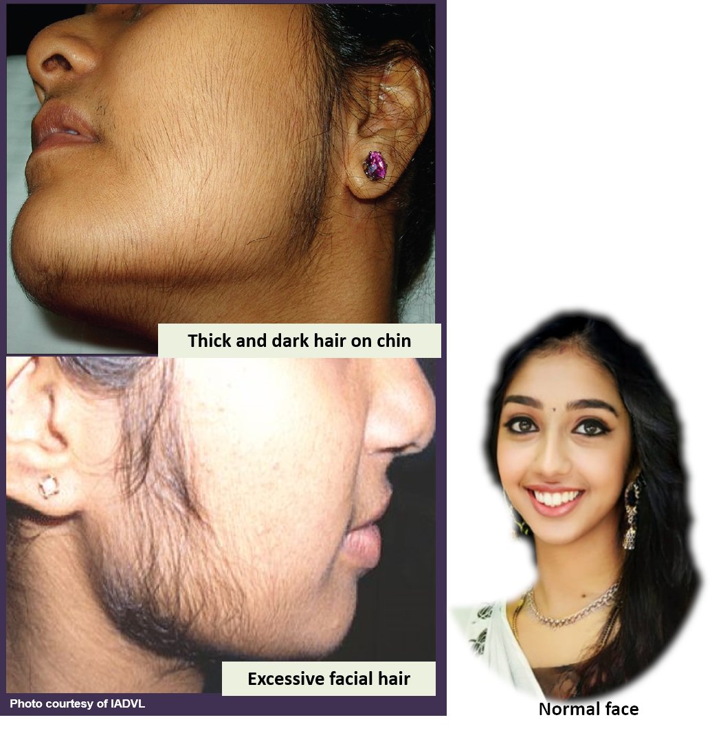 Hirsutism Face