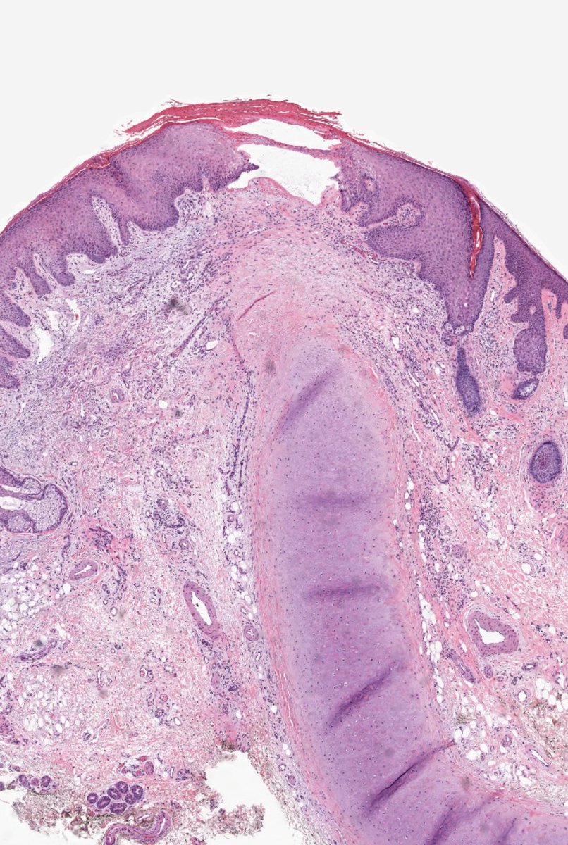 Chondrodermatitis Nodularis Helicis Histology