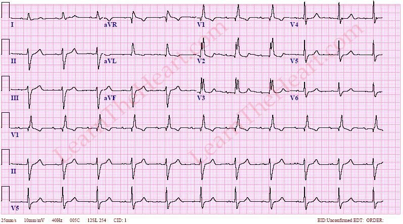 Lafb Rbbb Ecg