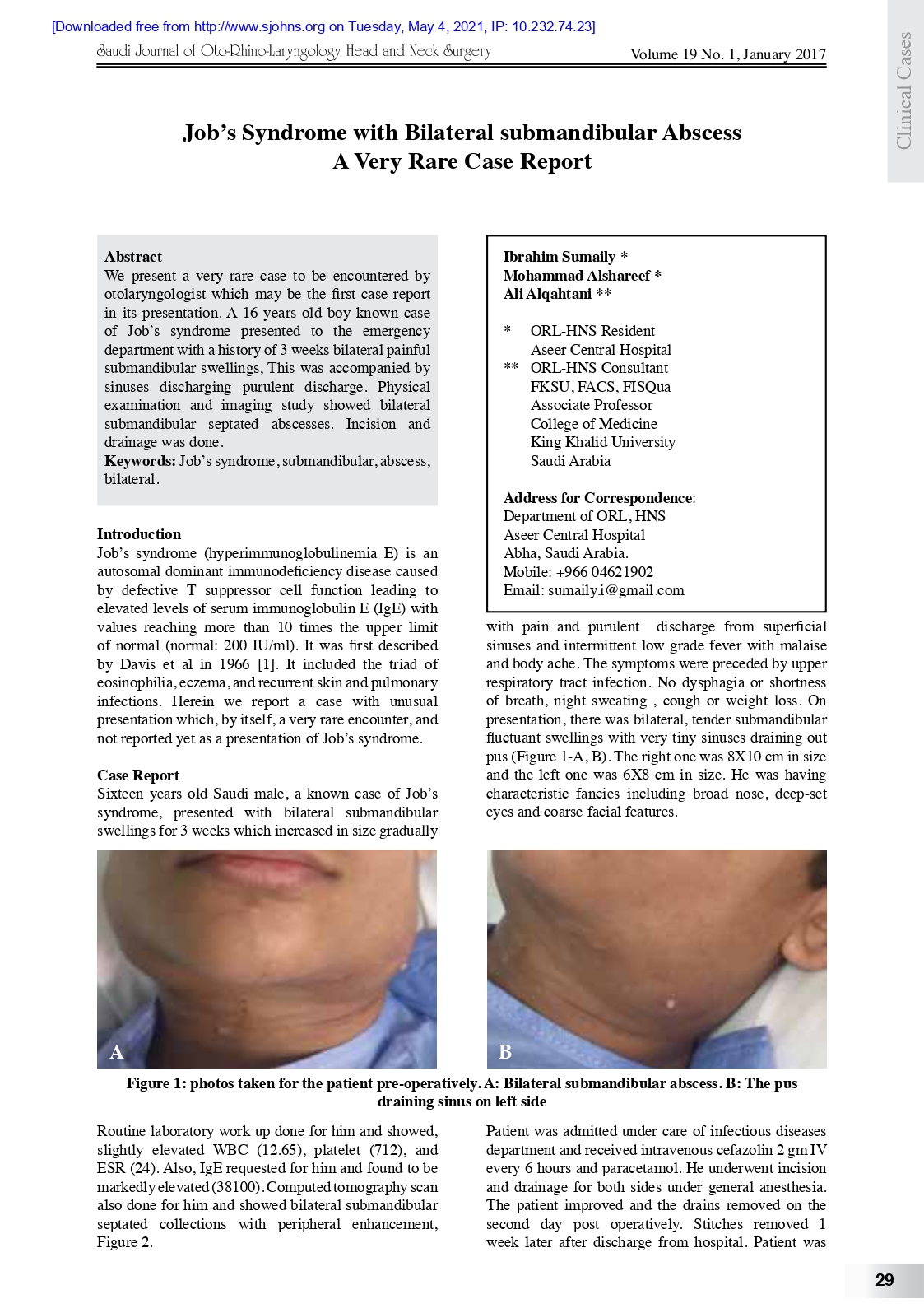 Submandibular Abscess