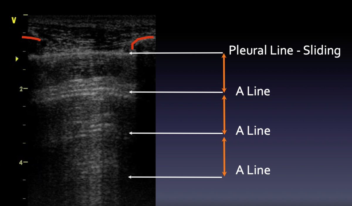 Essential of lung/diaphragm #POCUS tutorial 🧵 🦇 sign identify lung in ...