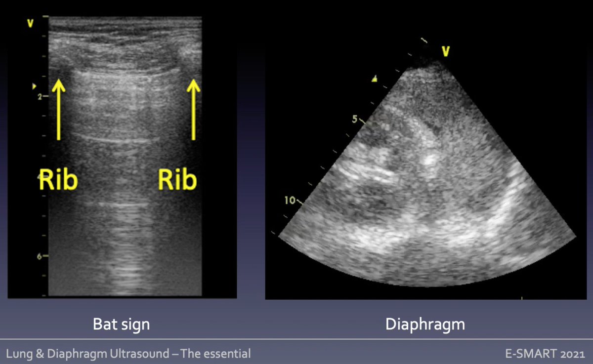 Essential of lung/diaphragm #POCUS tutorial 🧵 🦇 sign identify lung in ...