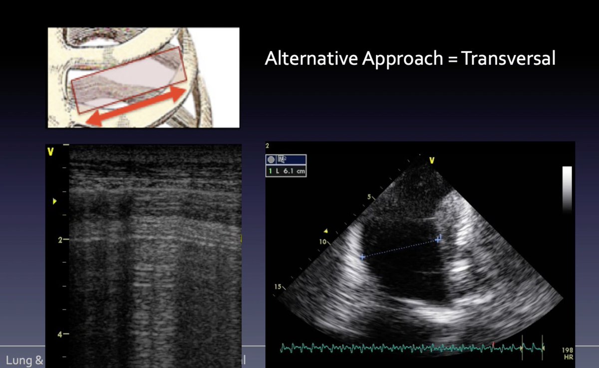 Essential of lung/diaphragm #POCUS tutorial 🧵 🦇 sign identify lung in ...