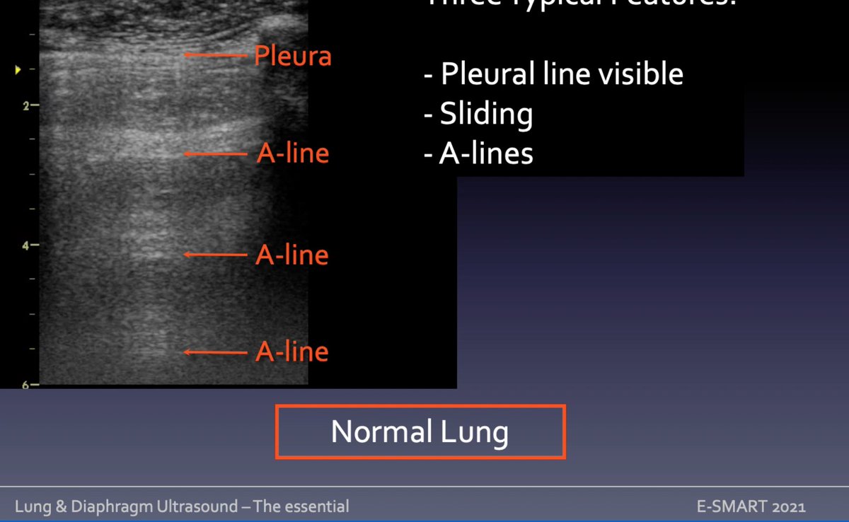 Essential of lung/diaphragm #POCUS tutorial 🧵 🦇 sign identify lung in ...