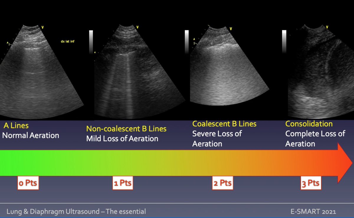 Essential of lung/diaphragm #POCUS tutorial 🧵 🦇 sign identify lung in ...