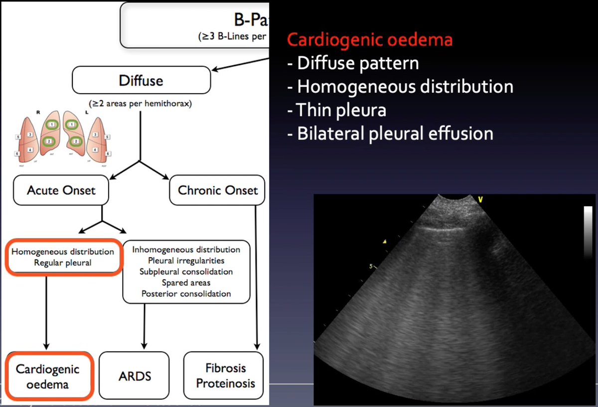 Essential of lung/diaphragm #POCUS tutorial 🧵 🦇 sign identify lung in ...