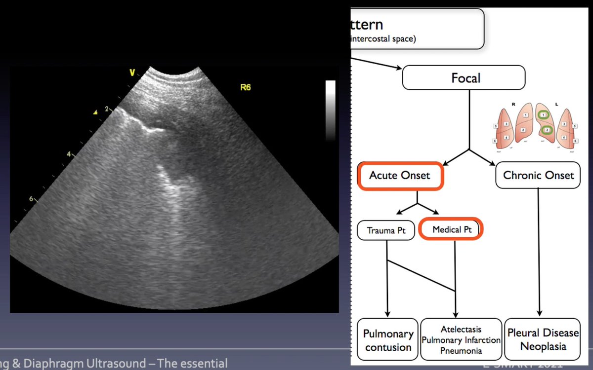 Essential of lung/diaphragm #POCUS tutorial 🧵 🦇 sign identify lung in ...