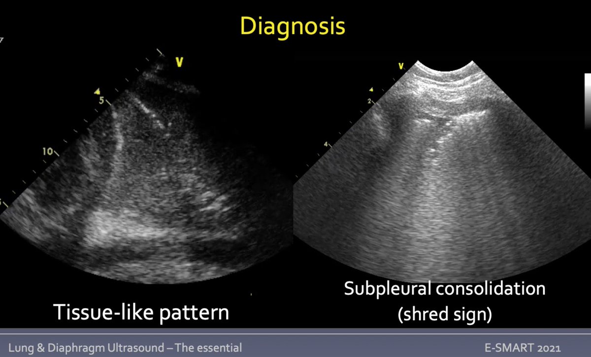 Essential of lung/diaphragm #POCUS tutorial 🧵 🦇 sign identify lung in ...