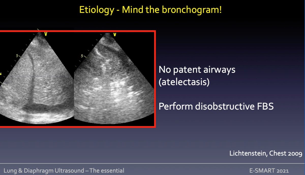 Essential of lung/diaphragm #POCUS tutorial 🧵 🦇 sign identify lung in ...